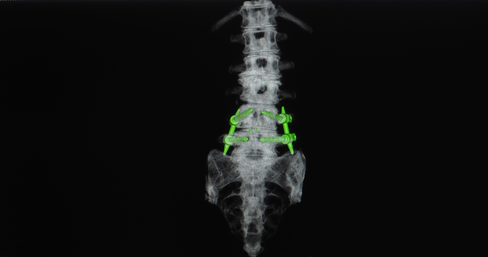 Techniques mini-invasives : Arthrodèse mini-invasive lombaire ...